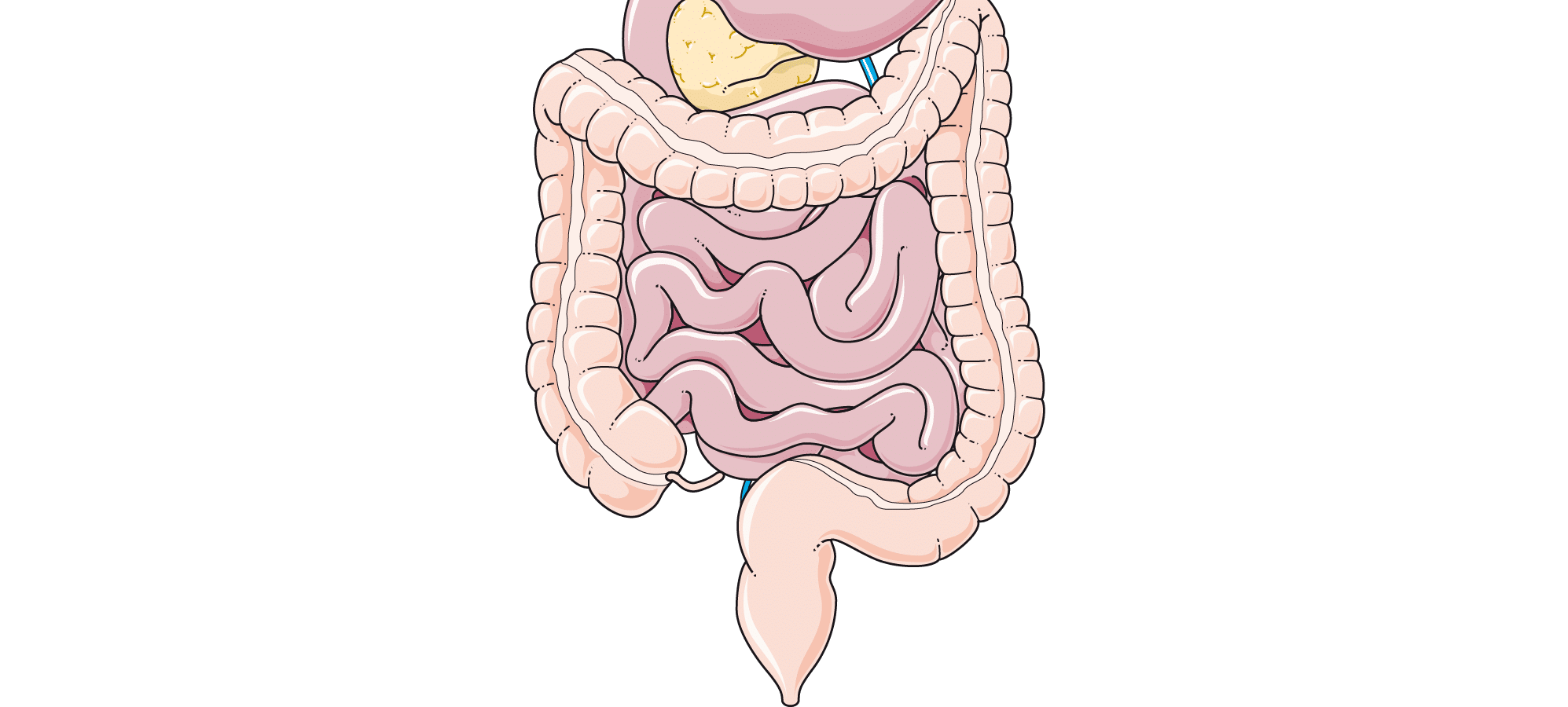 PD-L1 expression i stadium II kolon cancer