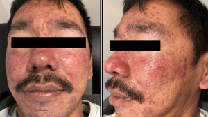 Rosacea Fulminans - Pyoderma Faciale
