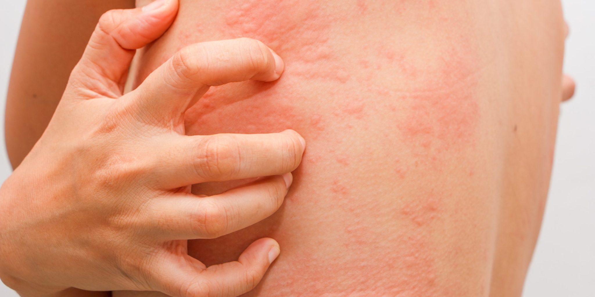 Dermatologists Frequently Encounter Harmful Cutaneous Adverse Reactions ...